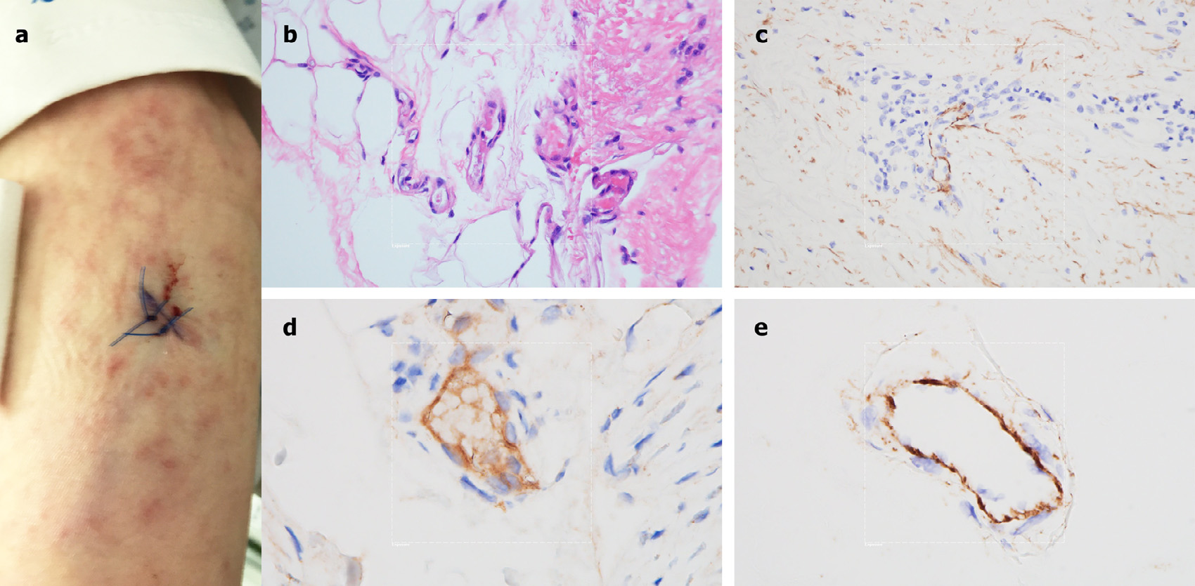 Blood Clots A Major Problem In Severe Covid 19 Blood Clots A Major Problem In Severe Covid 19
