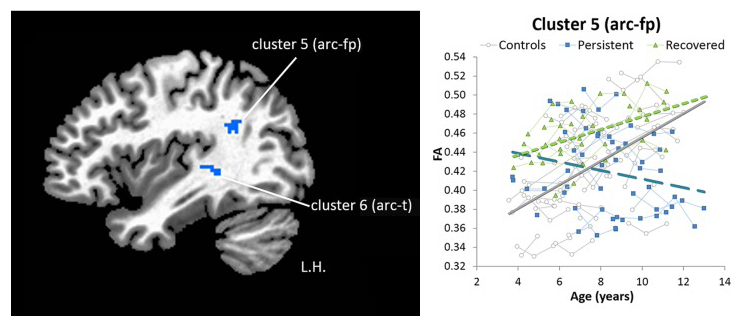 The new neuroscience of stuttering